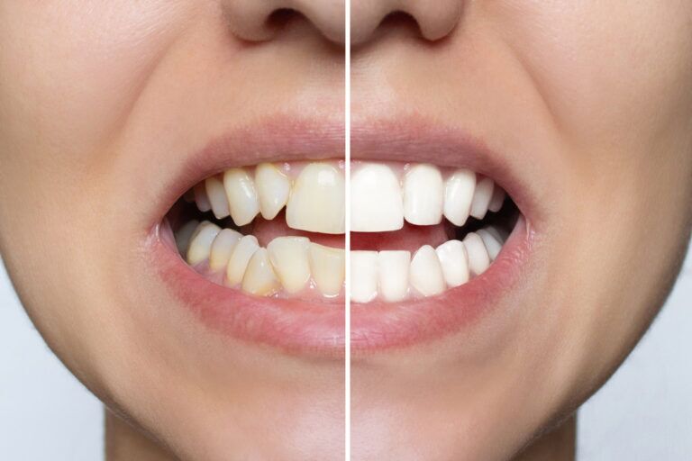 How Long Do Dental Veneers Last and When Should You Replace Them ...