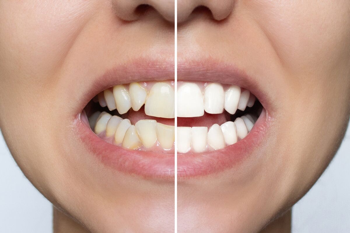 How Long Do Dental Veneers Last and When Should You Replace Them ...